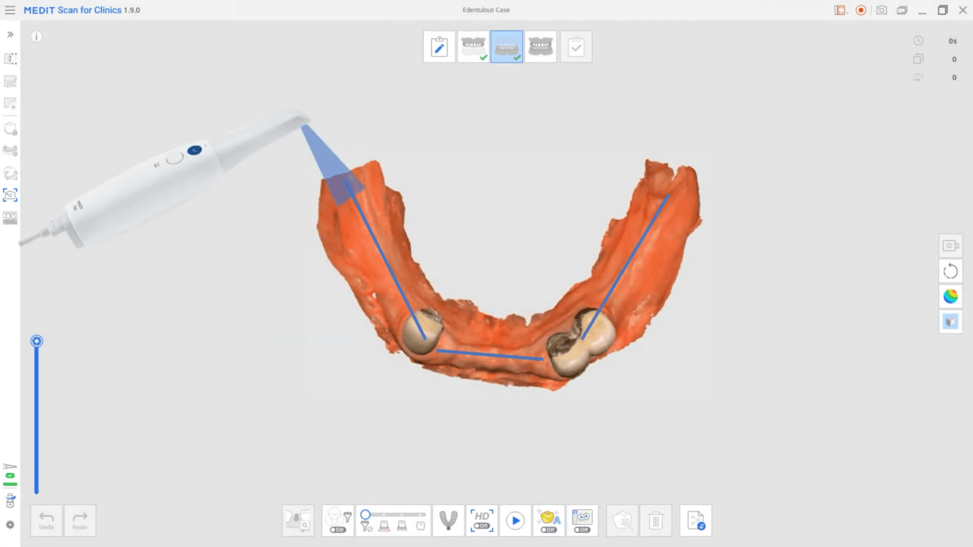 Dominio del escaneado de edéntulos - Escáner intraoral MEDIT y software ...